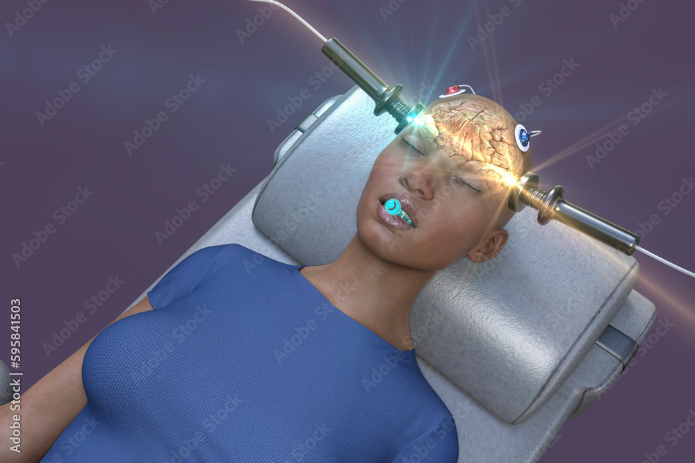 Electroconvulsive therapy, ECT, a treatment involving the use of ...