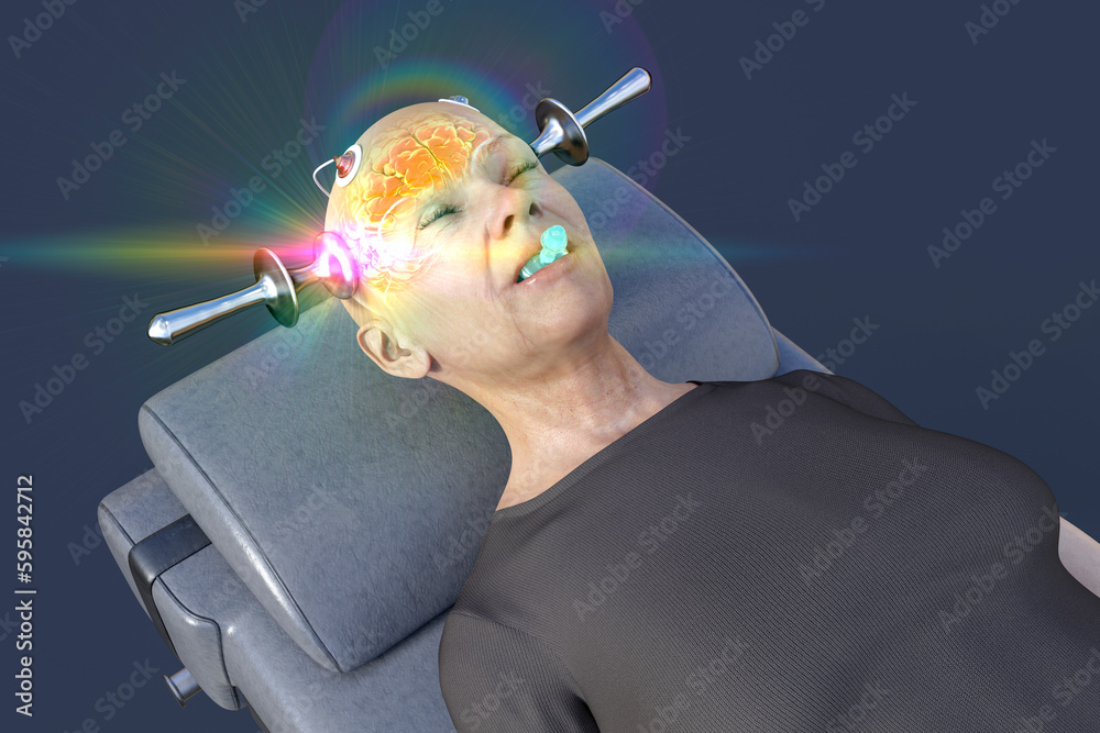 Electroconvulsive therapy, ECT, a treatment involving the use of ...