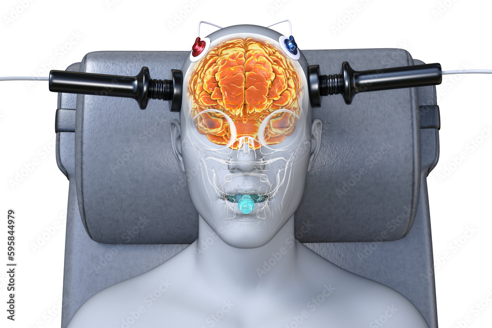 Electroconvulsive therapy, ECT, a treatment involving the use of ...