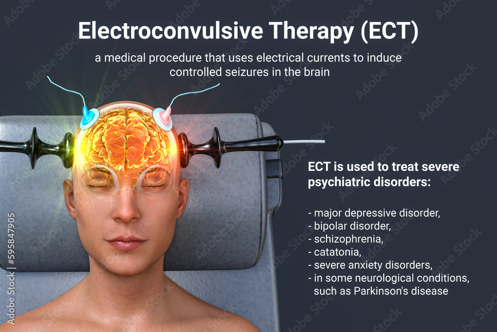 Electroconvulsive therapy, ECT, a treatment involving the use of ...