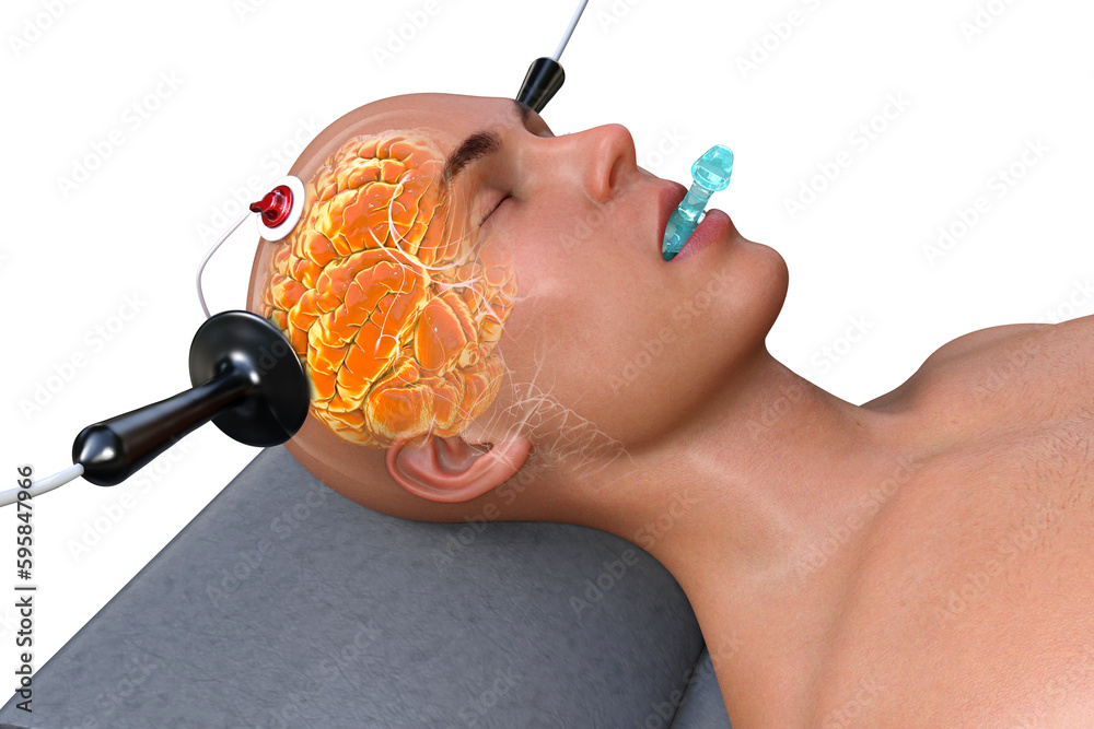 Electroconvulsive therapy, ECT, a treatment involving the use of ...