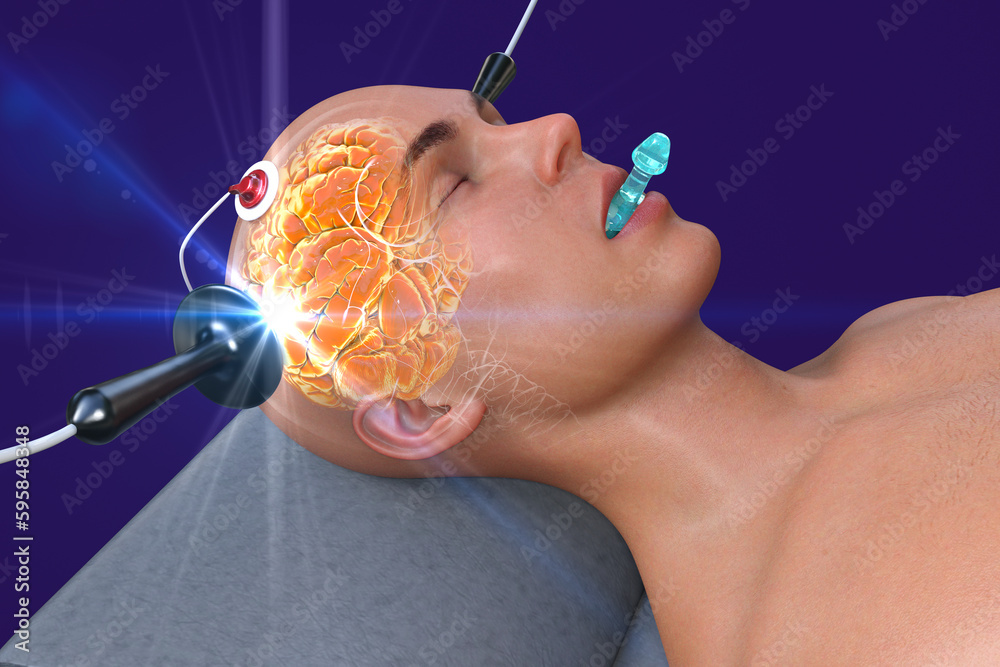 Electroconvulsive therapy, ECT, a treatment involving the use of ...