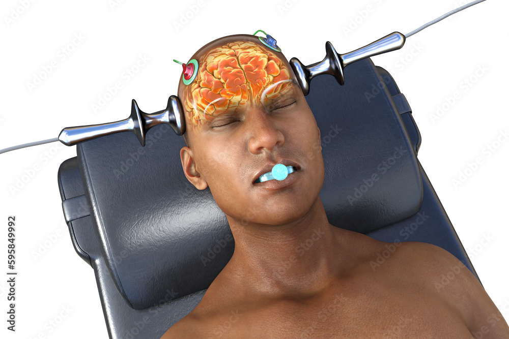 Electroconvulsive therapy, ECT, a treatment involving the use of ...