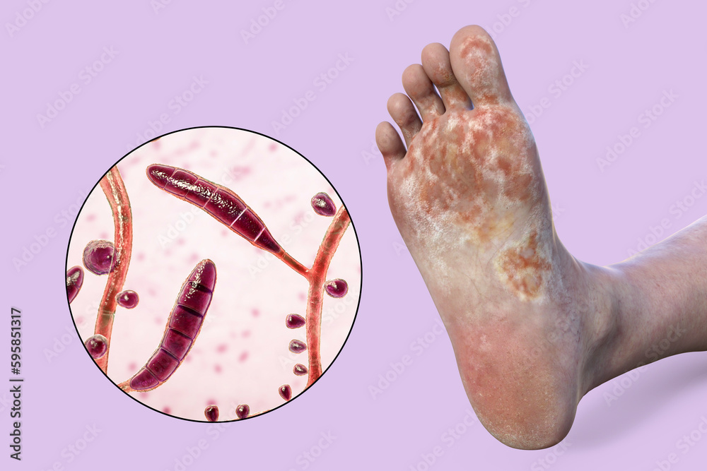 The foot with mycosis, and close-up view of fungi Trichophyton rubrum ...