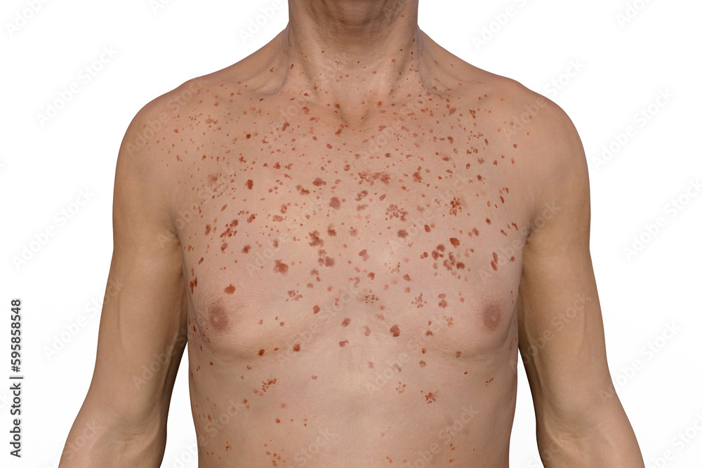 A skin rash on the chest of a patient with Marburg hemorrhagic fever ...