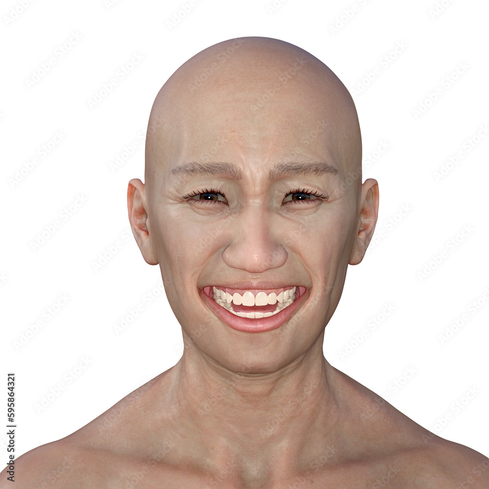 A 3D illustration depicting a person suffering from tetanus, shown with ...