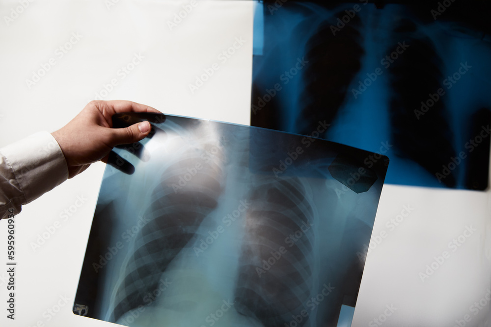Doctor's hand with lung x-rays in front of exam room and lung x-rays ...