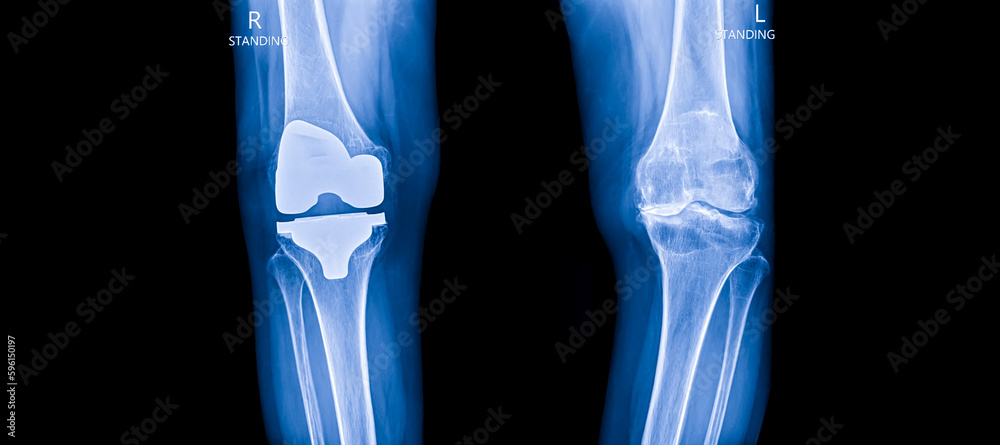 Blue tone of xray image in orthopedic unit inside hospital on black ...