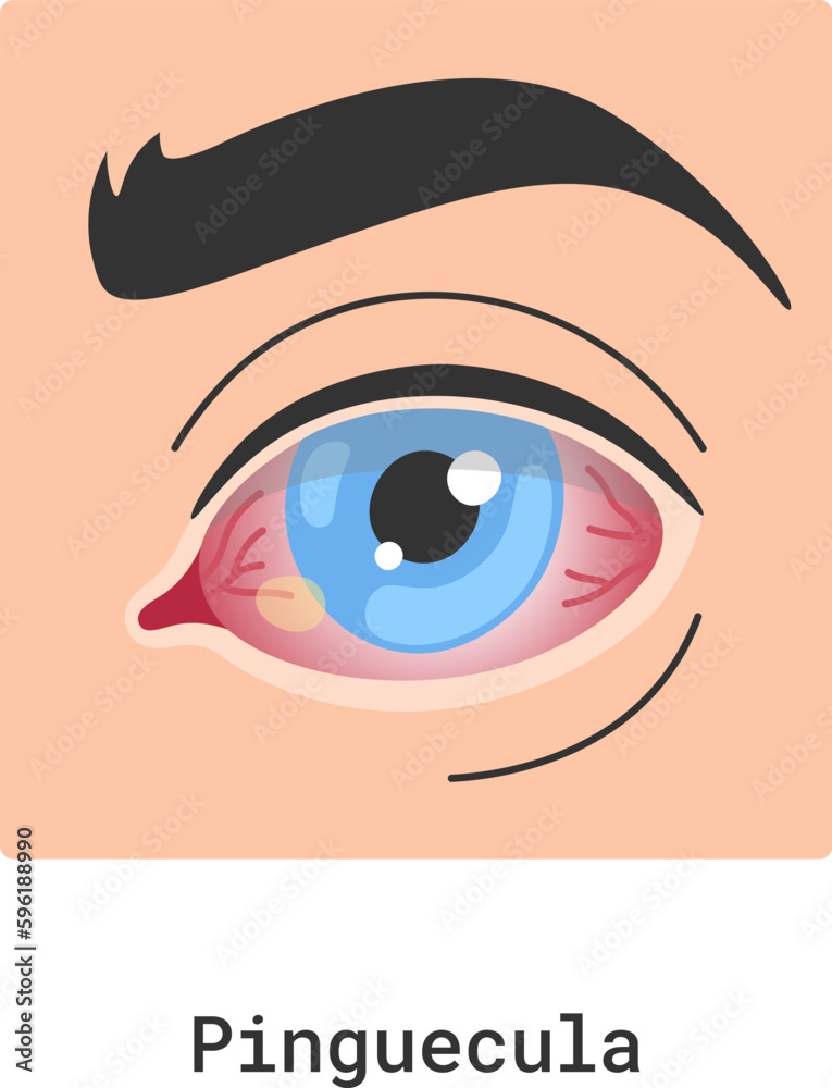 Pinguecula Human Eye Disease Stock Vector | Adobe Stock