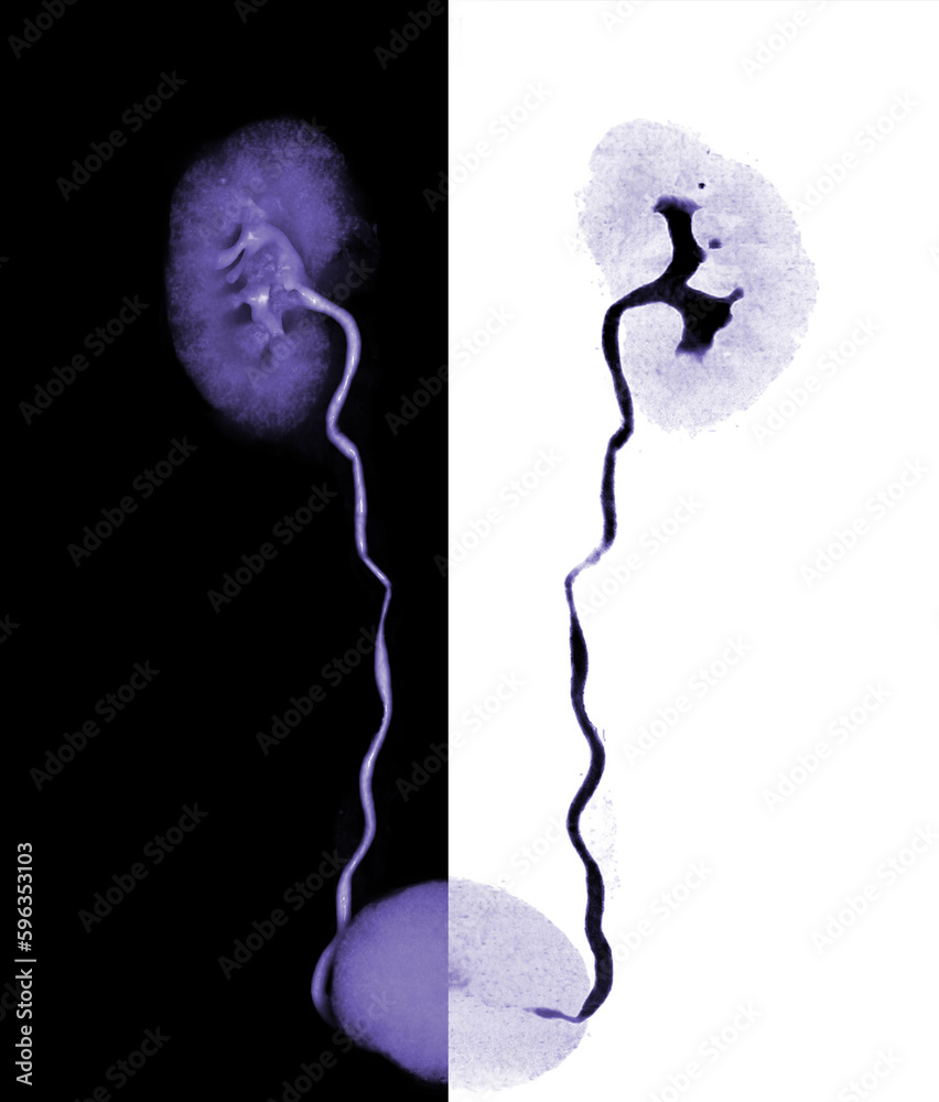CTA Renal artery 3D rendering image showing both kidney, Ureter and ...