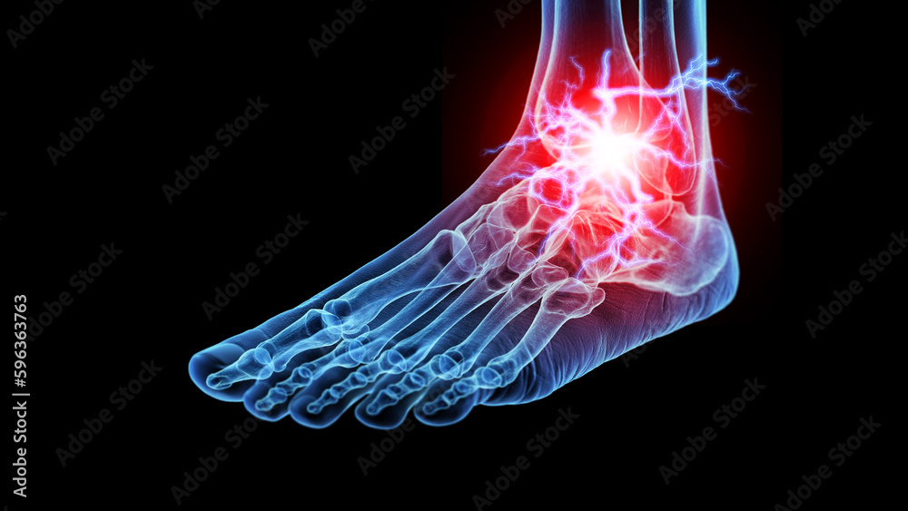 3D Rendered Medical Illustration of foot pain Stock Illustration ...