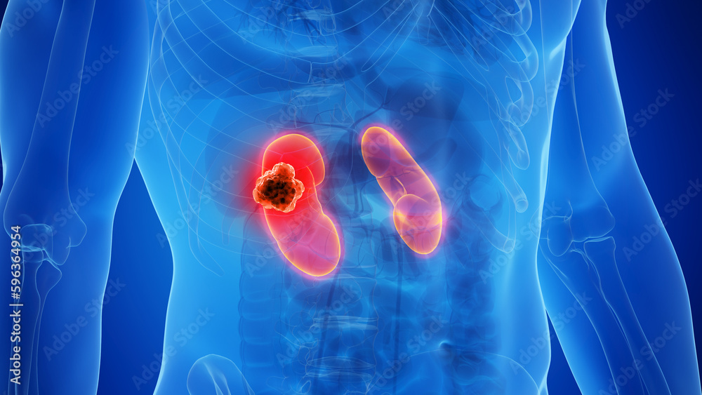 3D Rendered Medical Illustration of Male Anatomy - Kidney Cancer. Stock ...