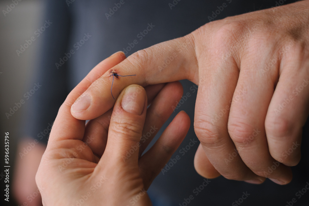 Inspection of seam on finger after removal of dermatofibroma Stock ...