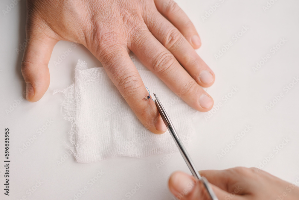 Removal Of Suture On Finger Of Patient In Clinic Inspection Of Seam On