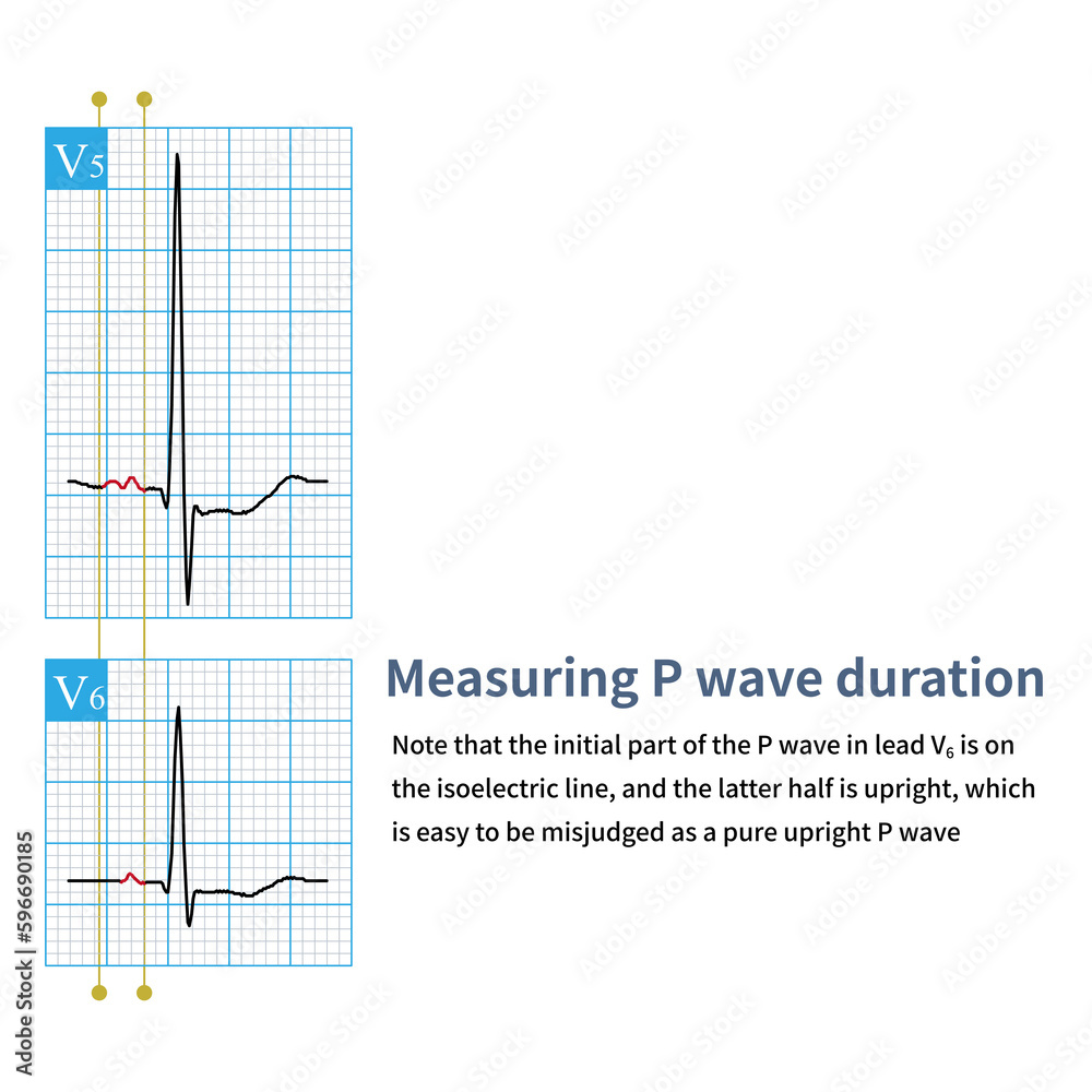 It is best to choose a synchronous 12-lead ECG to measure the earliest ...