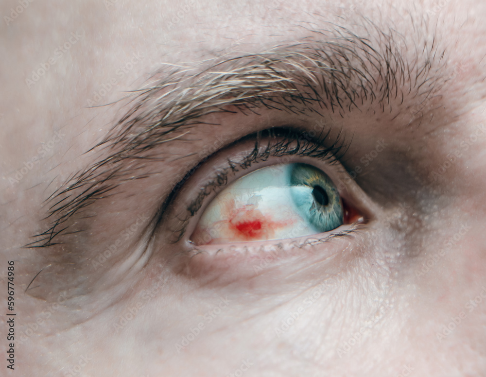 The eye of a man with a bursting vessel in the eyeball. Hemorrhage in ...