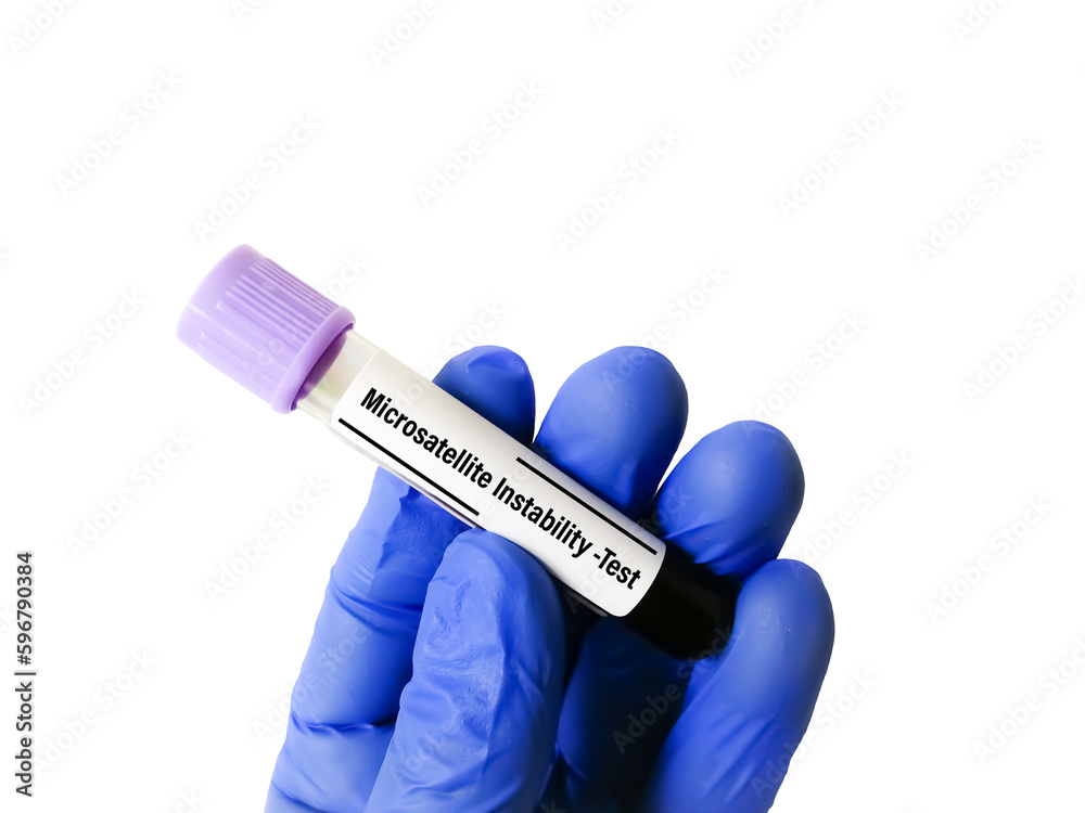 Microsatellite Instability (MSI) test,MSI screening is used to see the ...