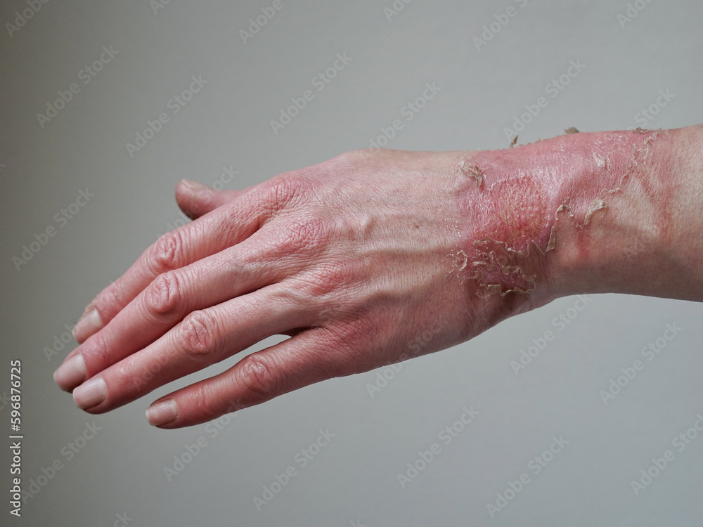 Close-up of a woman's hand with a burst blister from a boiled water ...