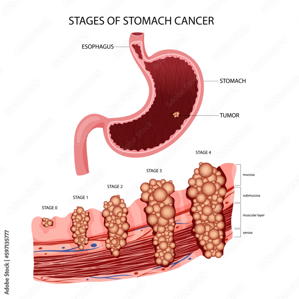 Stomach cancer. Stages growth malignant cancerous tumor. Anatomical ...