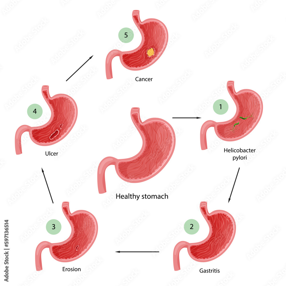 Stomach diseases. Diagram of diseases of helicobacter pylori, gastritis ...