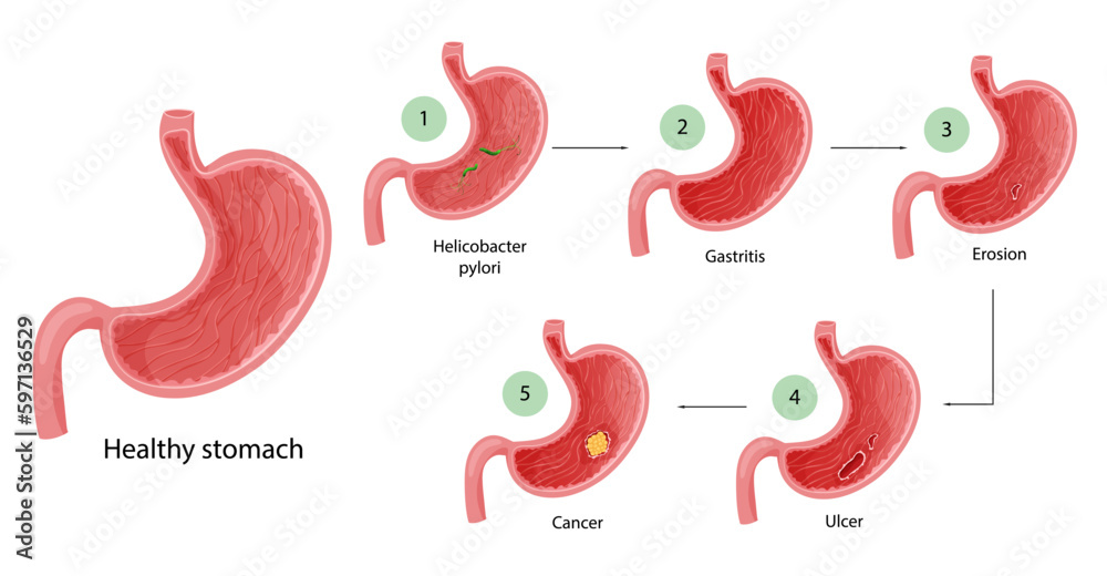 Stomach diseases. Diagram of diseases of helicobacter pylori, gastritis ...