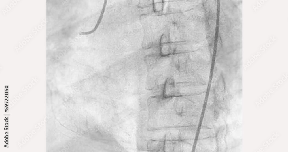 Cardiac catheterization showing coronary arteries used to diagnose and ...