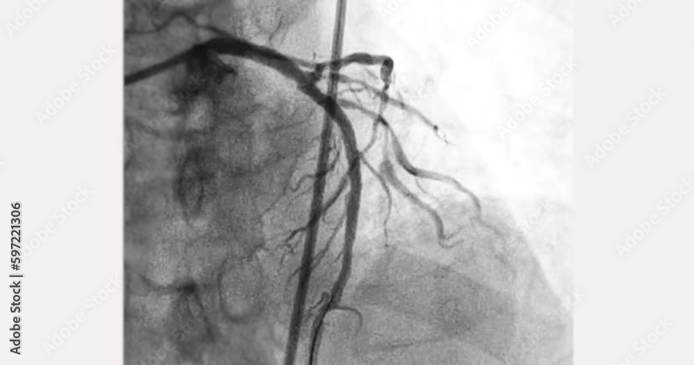 Cardiac catheterization showing coronary arteries used to diagnose and ...