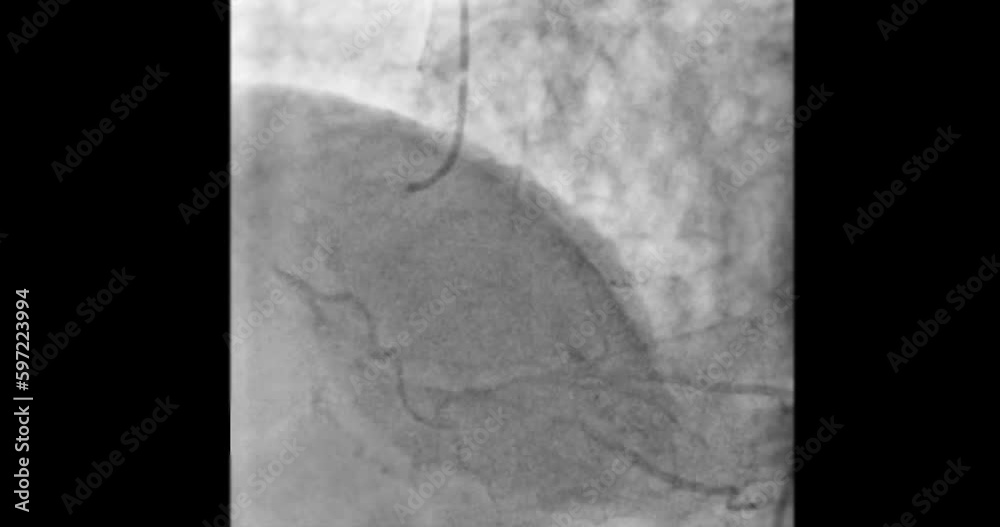 Cardiac catheterization showing coronary arteries used to diagnose and ...