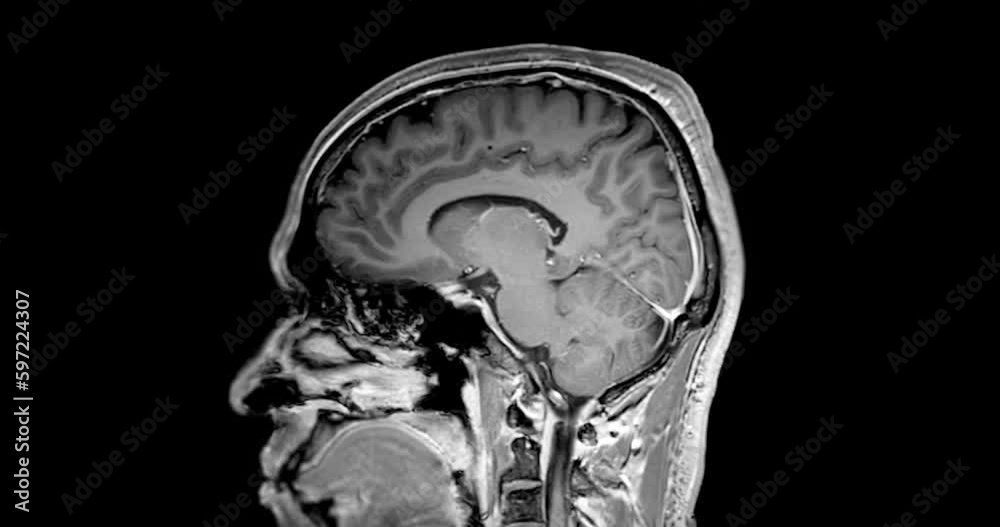 MRI of the brain sagittal T1 with gadolinium contrast media for diagnosis brain tumor and stroke ...