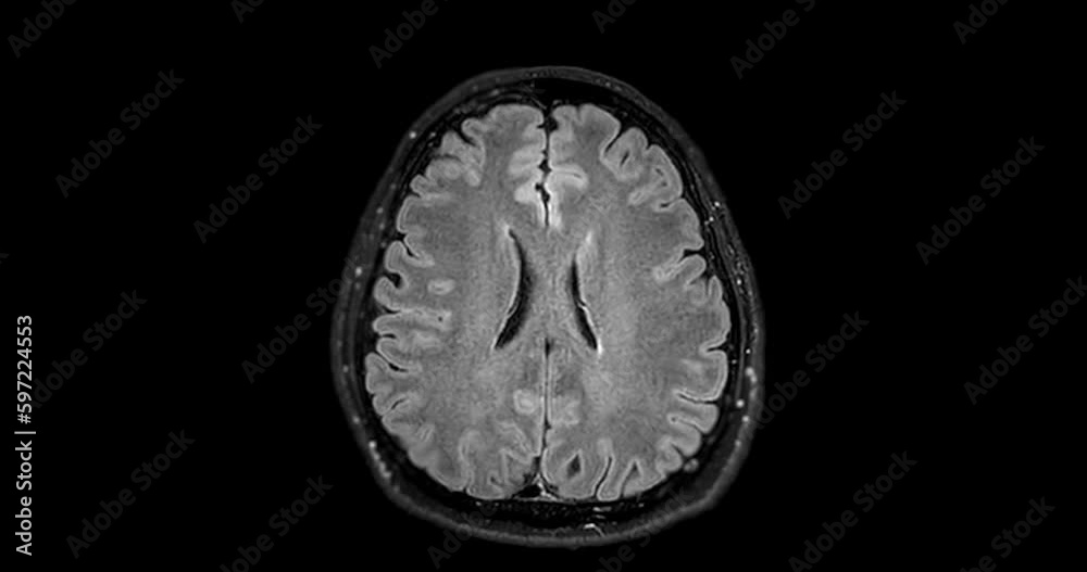 MRI of the brain Axial flair for diagnosis brain tumor and stroke ...