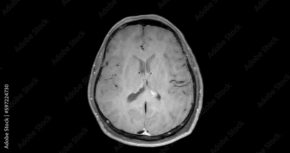 MRI of the brain axial SWI with gadolinium contrast media for diagnosis ...