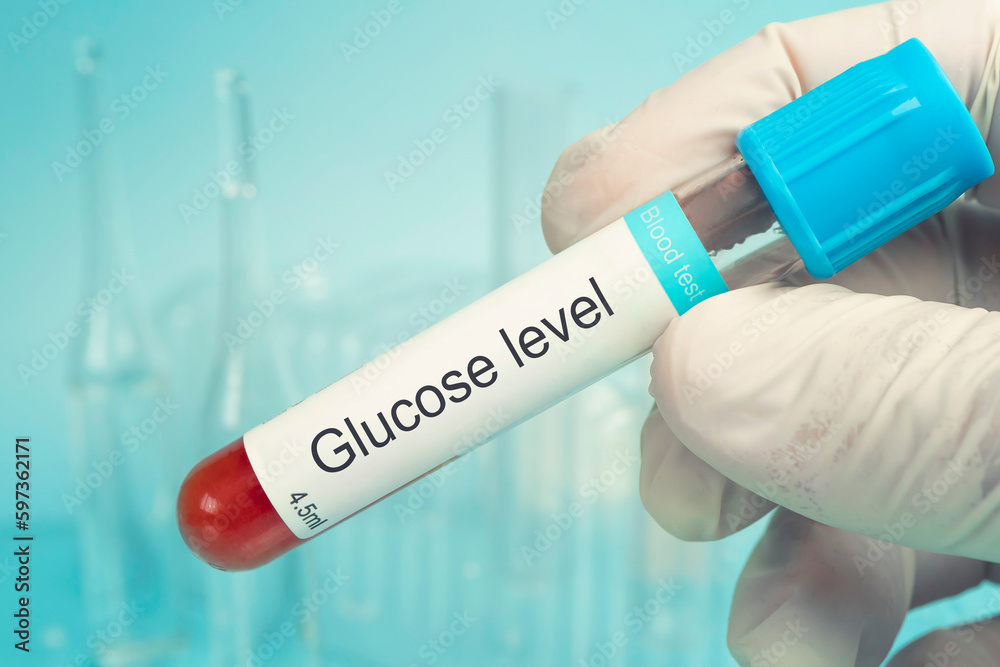 Scientist hold a sample tube of Glucose test, diagnosis of ...