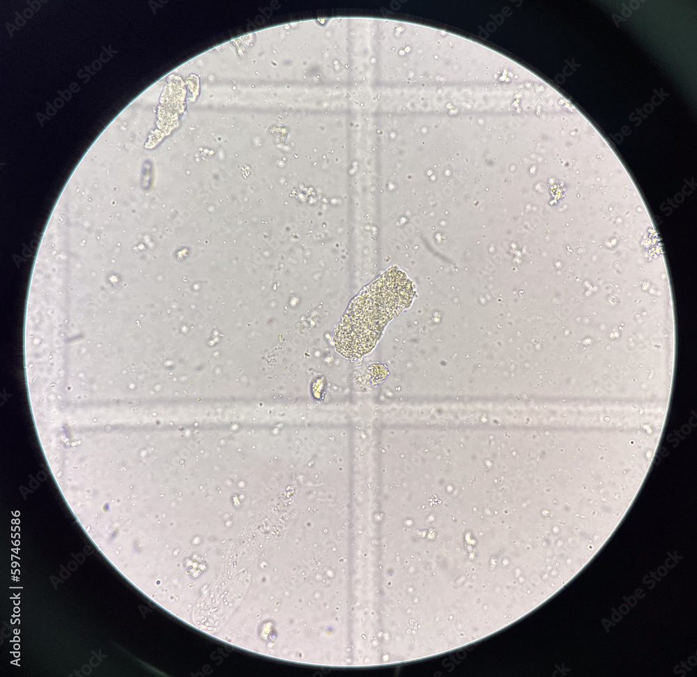 Cast in fresh urine finding with microscope. Stock Photo | Adobe Stock