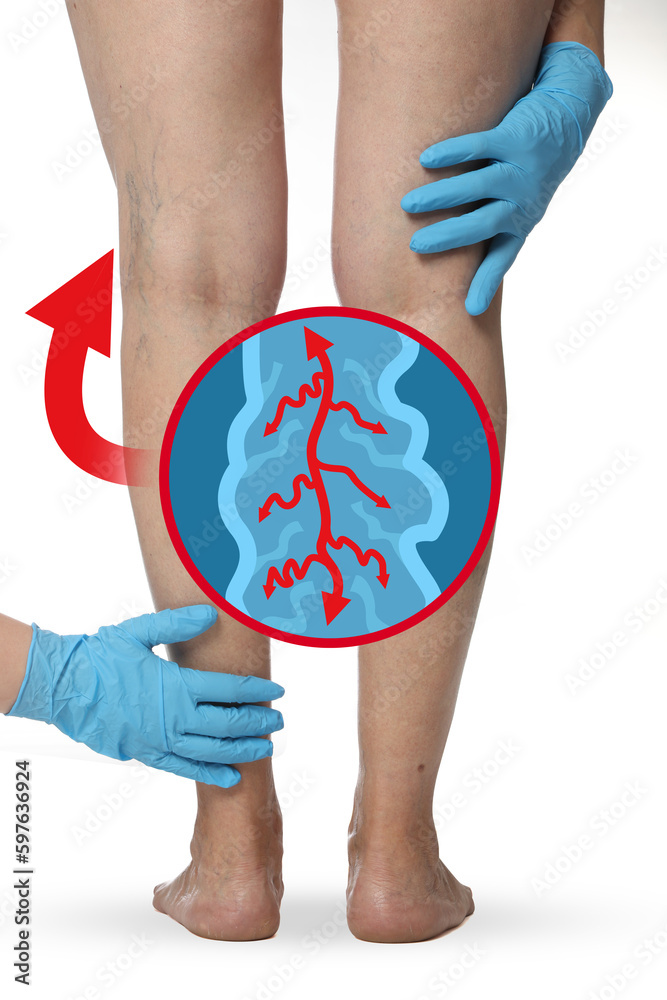Doctor examining patient with varicose veins on legs against white ...