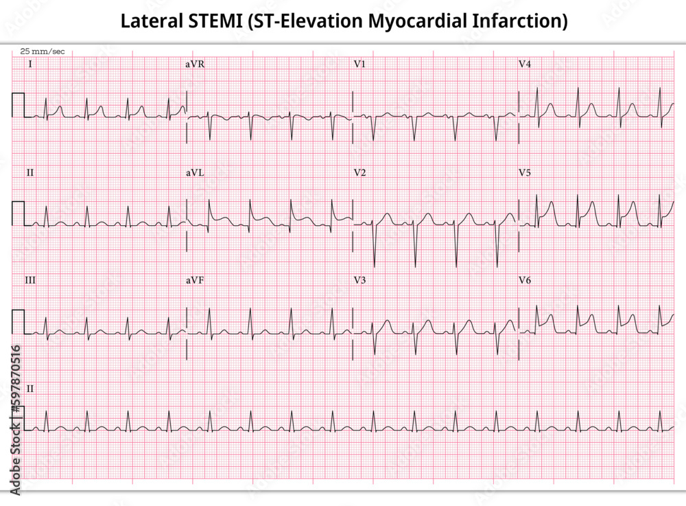 Plakat Lateral ST-Elevation Myocardial Infarction (STEMI) - 12 Lead ECG ... Plakat Lateral ST-Elevation Myocardial Infarction (STEMI) - 12 Lead ECG ...