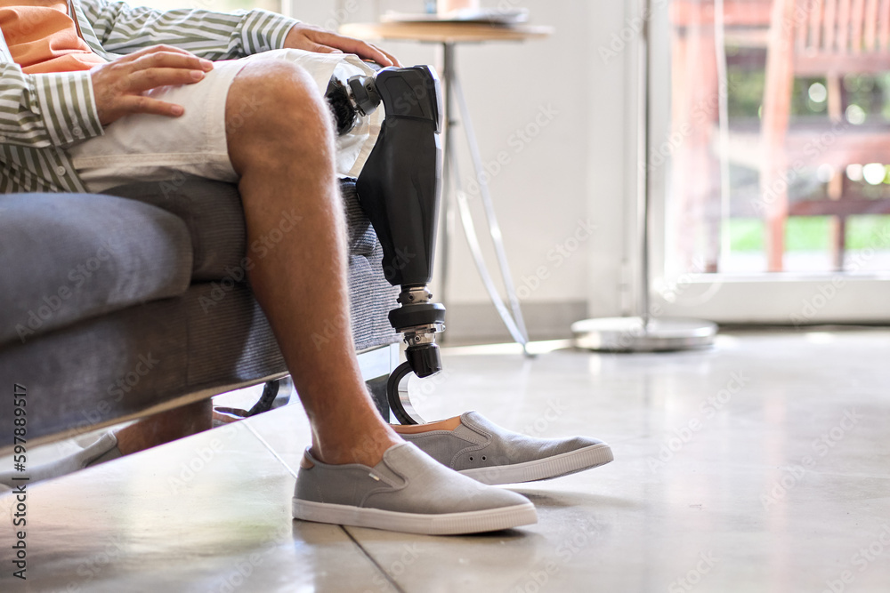 Man amputee with prosthetic leg disability on above knee transfemoral ...