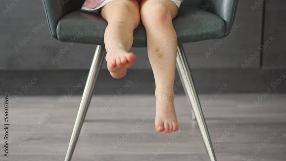 Close up of stains bruise wound on legs of little girl. Extravasation ...