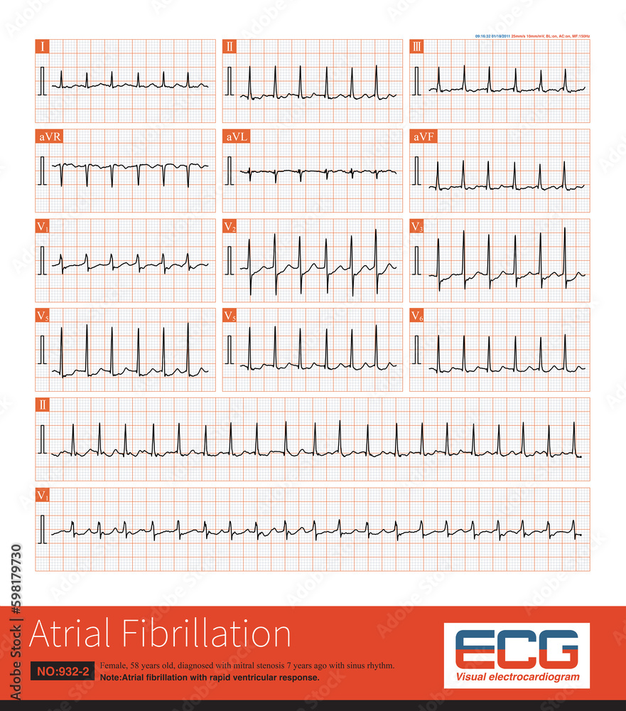 A 58-year-old woman was clinically diagnosed with mitral stenosis, and her electrocardiogram ...
