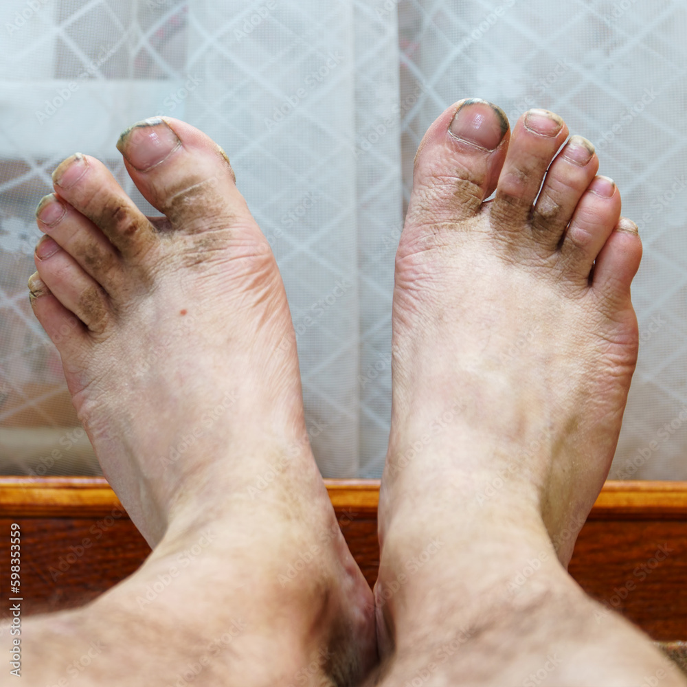 A view of dirty unkempt feet and dirty nails without a pedicure Stock ...