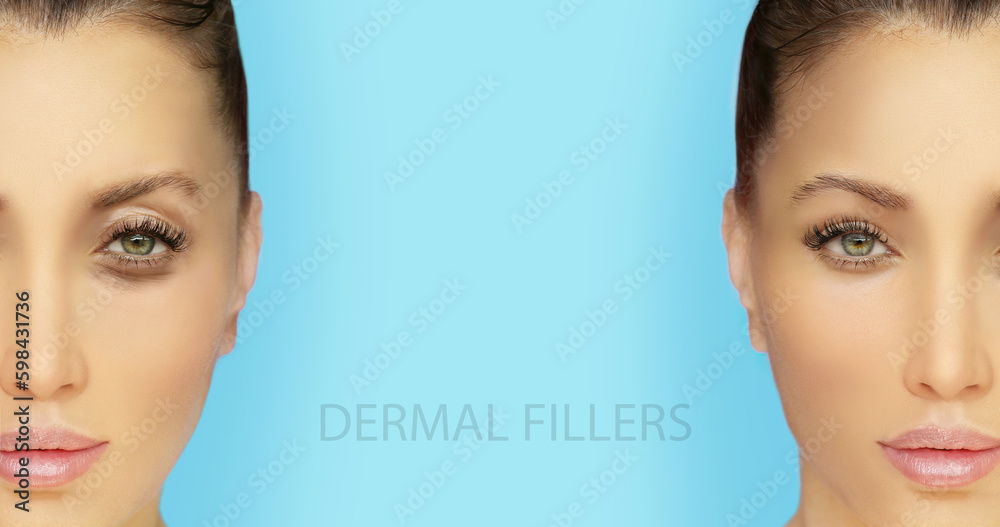 Tear Trough Filler,A-frame deformity. Fat grafting or dermal filler ...