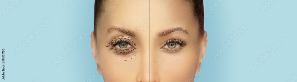 Lower and upper Blepharoplasty.Marking the face.Perforation lines on ...