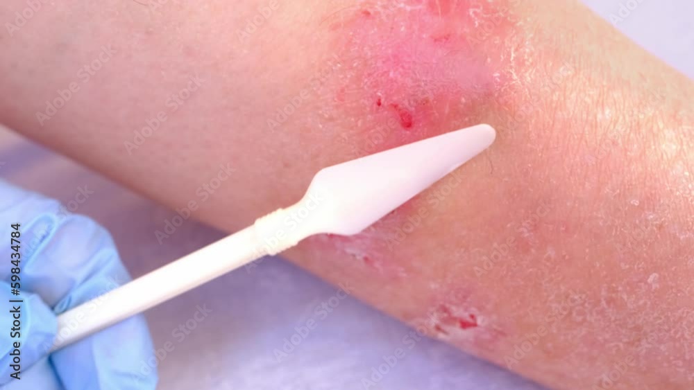 doctor treats large healing wound from on lower leg with scars of adult ...