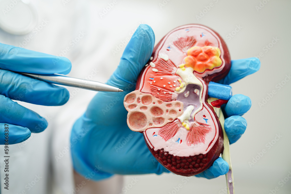 Chronic kidney disease, doctor holding model for treatment urinary ...