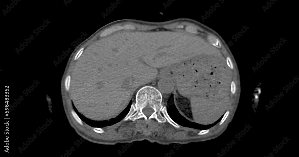 CT Chest or CT Scan of Lung with lung filter for diagnosis TB,tuberculosis and coronavirus or ...