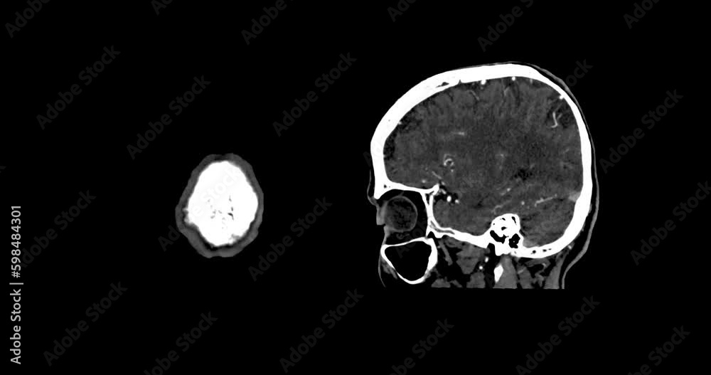 CT scan of the brain Axial and sagittal view with injection contrast ...