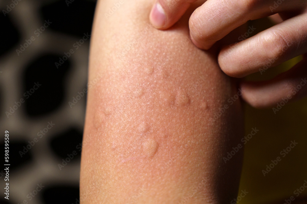 Skin texture, allergy shot, weeds, reaction. Allergy symptoms ...