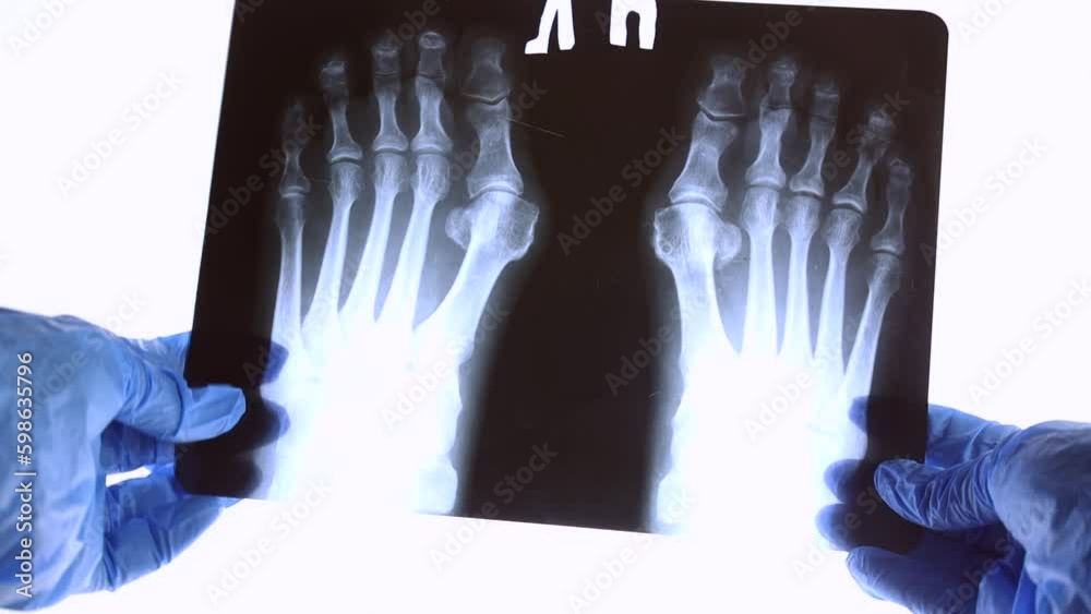 Doctor hands with blue medical x ray scan of feet and toes with Hallux ...
