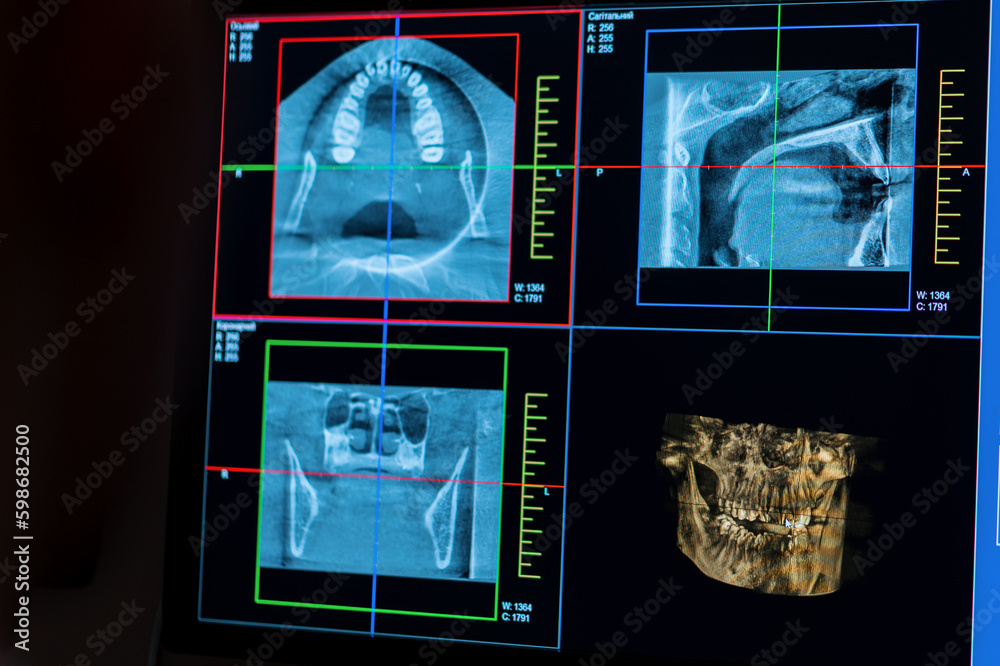 scanning of teeth on an X-ray image of a patient's jaw on a computer ...