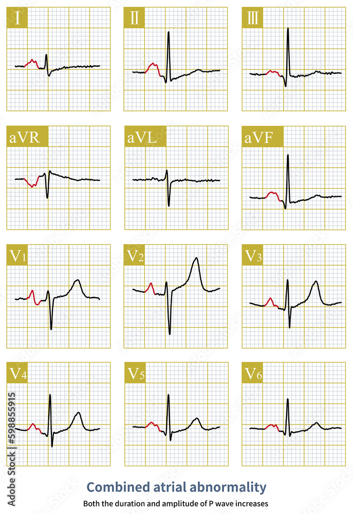 When the duration and amplitude of sinus P waves increase, it is called ...