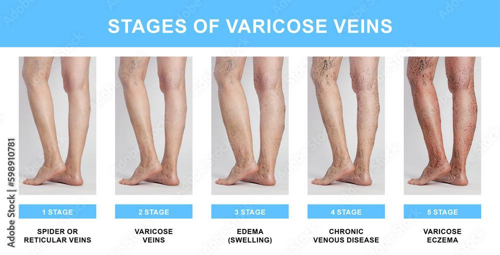 Stages of varicose veins. Collage with photos of woman showing changes ...